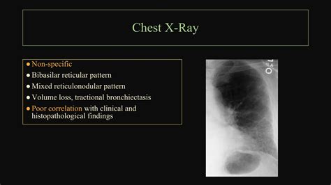 Interstitial Lung Disease Pattern Approach Main Pptx
