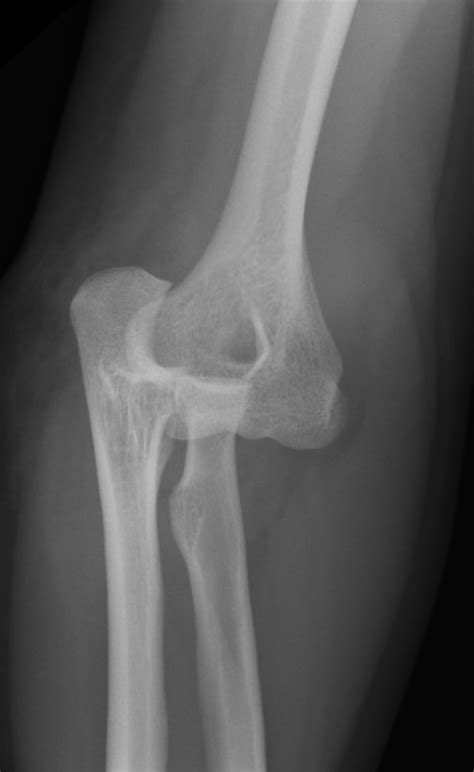 Elbow Dislocation Trauma Orthobullets