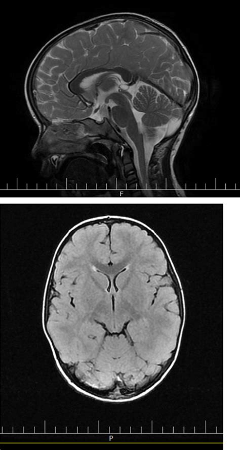 Brain Mri In A Subject With Ataxia‐telangiectasia When Aged 2 Years Old