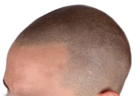 Smp Scalp Micropigmentation Smp Scalp Micropigmentation