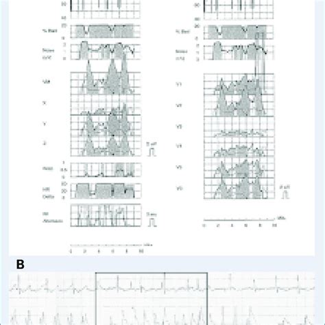 Positive Microvolt T Wave Alternans In A Patient With Ischemic Download Scientific Diagram