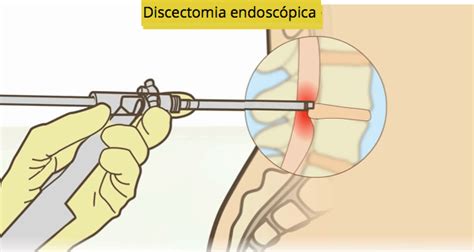 discectomia-endoscópica-hernia-de-disco | Saúde – Blog OPAS
