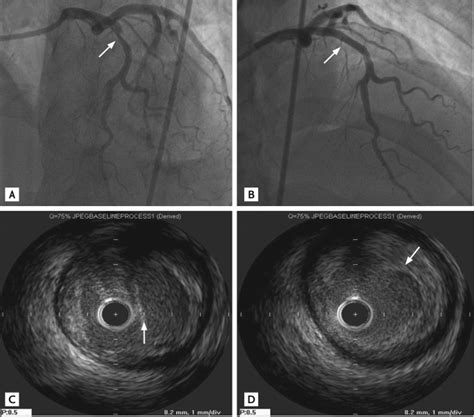 A Coronary Angiography Revealing Intimal Dissection Arrow In Mid