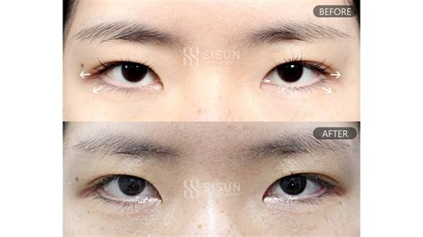 Banda 듀얼트임｜뒤트임밑트임4주 Youtube