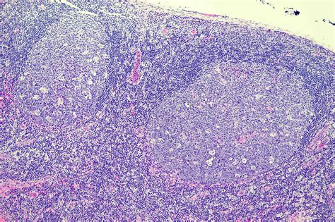 Follicular Lymphoma Pathology Outlines Follicular Lymphoma Updates