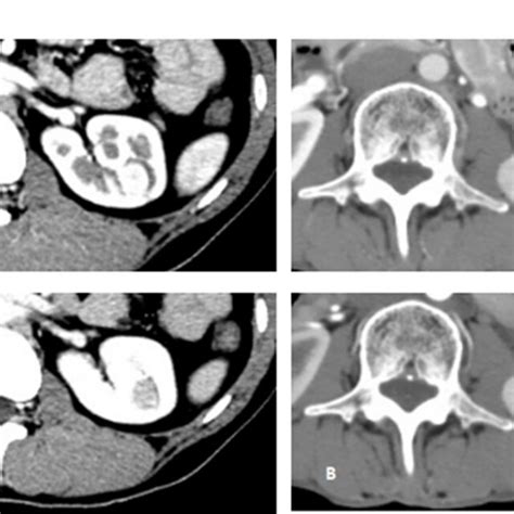 Ct Enhancement Mode Figure 3 A Shows That The Ct Enhancement Scan Of