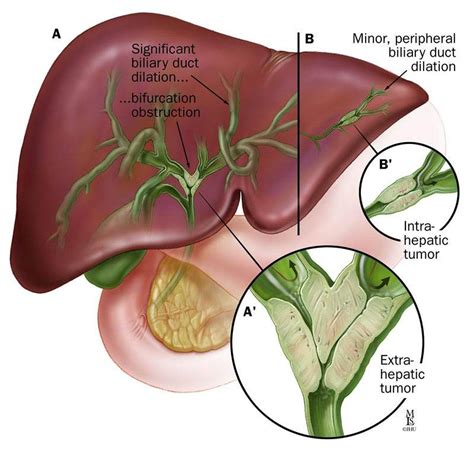Clogged Bile Duct Gallbladder Disease Types Symptoms And Treatment