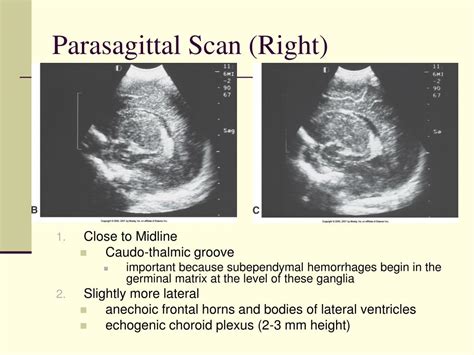 Ppt Neonatal Echoencephalography Powerpoint Presentation Free