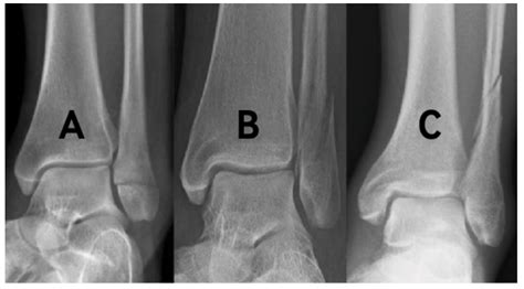 Weber Fractures — Kwak Talk