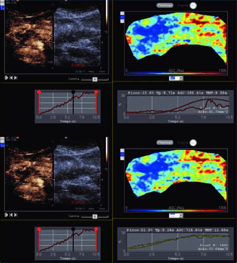 18 Pancreatic Adenocarcinoma Quantitative Perfusion Analysis At Ceus