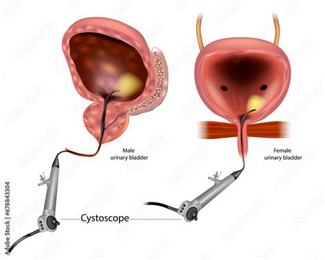 Diagram Showing A Flexible Cystoscopy For A Man And A Woman Anatomy Male And Female Urinary