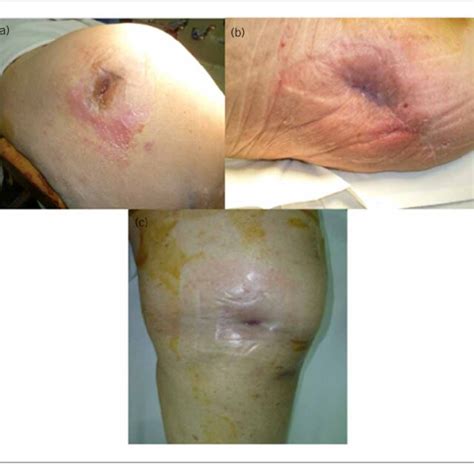 Clinical Images Showing The Patient In The Left Lateral Decubitus