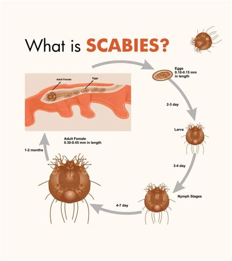 Scabies Symptoms Prevention And Treatments How Do You Get Scabies