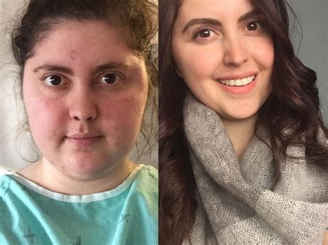 Moon Face Disease