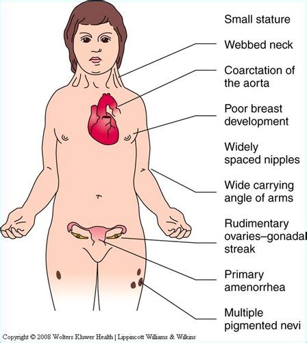 Turner Syndrome Ambiguous Genitalia Turner Syndrome Ambiguous Genitalia