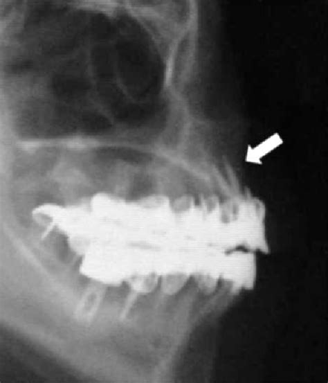 Radiography Showed A Maxillary Bone Defect Around The Implants Arrow Download Scientific
