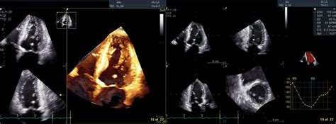 Automated 3 Dimensional Assessment Of Left Ventricular Volumes And Download Scientific Diagram