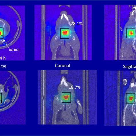 the 24 h thyroid single photon emission computed tomography spect
