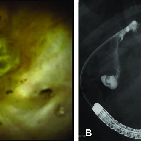 Pdf Temporary Placement Of A Fully Covered Self Expandable Metal Stent With Electrohydraulic