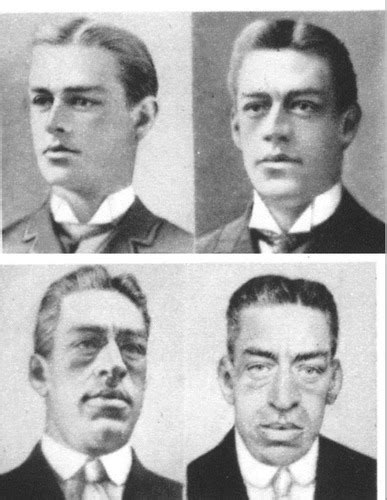 Phys II Lectuer 21 Endocrine Pathophys Flashcards Quizlet