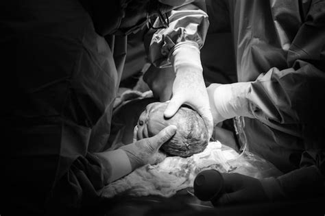 Premium Photo Cesarean Section The Operation Is In Process