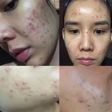 Acne Skin สิวหนักกว่าจะหาย รักษายังไง แกลเลอรีที่โพสต์โดย รีวิว