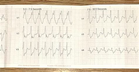 Svt With Aberrancy Or V Tach Album On Imgur