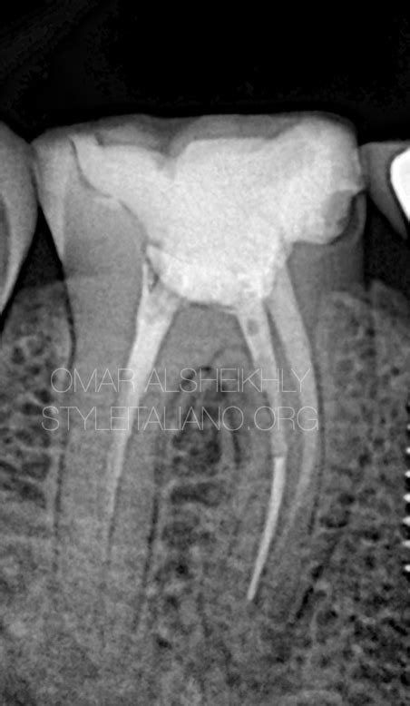 Management Of Separated Instrument Retrieve Bypass Or Leave It
