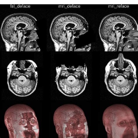 Example Of Successful Defacing Approaches On An Alzheimers Disease Download Scientific Diagram