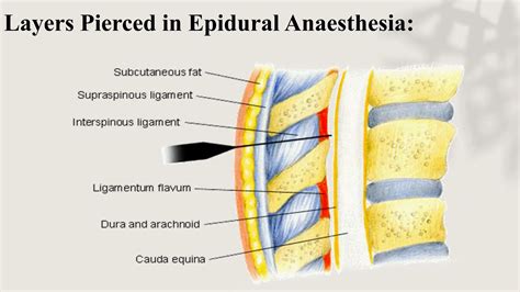 Spinal And Epidural Anaesthesia 5 1pptx