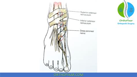 Tarsal Tunnel Syndrome Causes Symptoms And Treatment Options