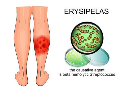 Connection Between Erysipelas And Cellulitis Infection Ecellulitis