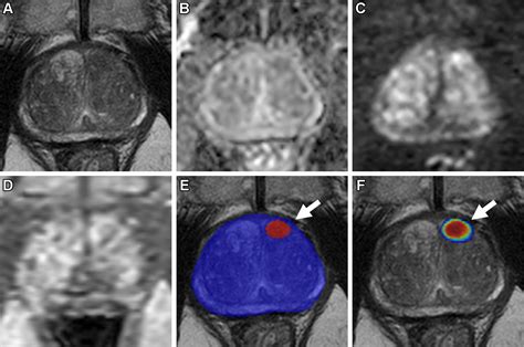evaluation of a cascaded deep learning based algorithm for prostate