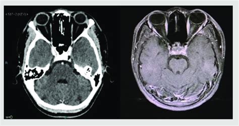 left image ct scan of the brain showed a normal orbital cavity