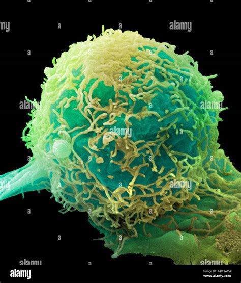Skin Cancer Cell Coloured Scanning Electron Micrograph Sem Cultured Melanoma Cell Showing