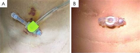 Vesicostomy With Bag