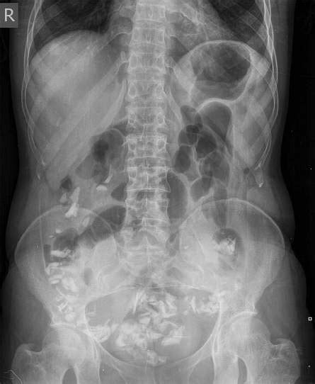 Abbreviations Ct Computed Tomography Git Gastrointestinal Tract Abbreviations Ct Computed Tomography Git Gastrointestinal Tract