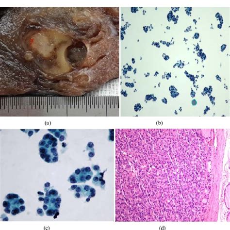 Benign Colloidal Nodules A Macroscopic Encapsulated Homogeneous Download Scientific
