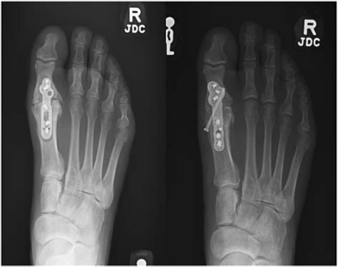 Medial Sesamoidectomy As A Local Autograft Source In Revision Or