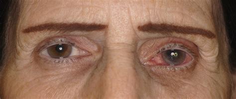 Pre Operative Photograph At Initial Presentation Showing Conjunctival
