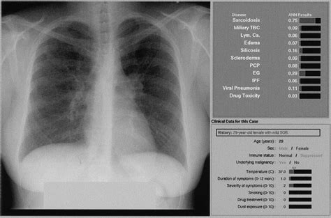 Interstitial Pneumonia Chest X Ray