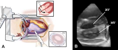 Figure 11 From Spatial Compounding And Segmentation Of Volumetric