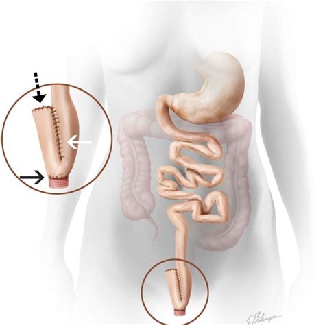 Illustration Of An Ileal Pouch Anal Anastomosis Ipaa A Colectomy And