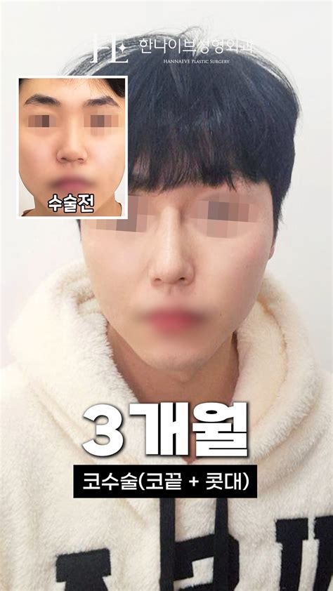 안양성형외과 한나이브 세련된 코라인 실제로 보면 더 예뻐요 😘 안양성형외과 범계성형외과 평촌성형외과 안양코성형 코성형 코재수술 콧대 코끝 코수술