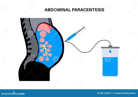 Abdominal Paracentesis Poster Stock Vector Illustration Of Peritoneum Medical 281136573