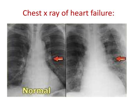 Differential Diagnosis Of Chest Pain Pptx