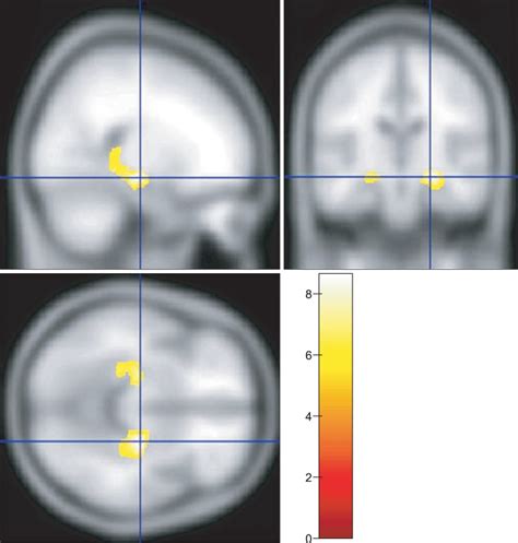 voxel based morphometry analysis showed the regions with significantly