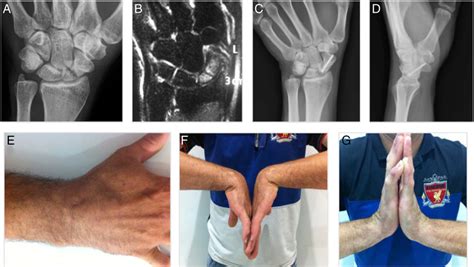 Scaphoid Fracture Surgery