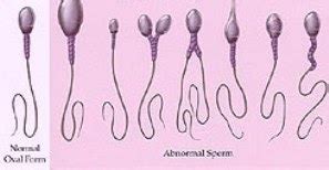 Infertility Guide: What Causes Abnormal Sperm Morphology?