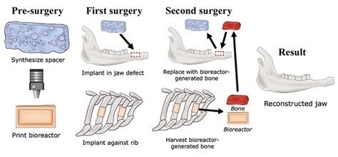 3d Printed Bioreactor Grown Bone For Craniofacial Surgery Applysci